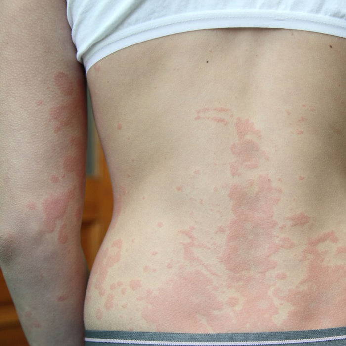 Allergisk reaktion: Symptomer, udseende og håndtering